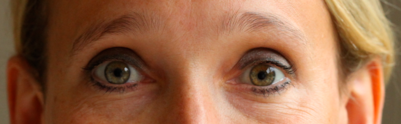 LostEyebrows.org – For people experiencing frontal fibrosing alopecia