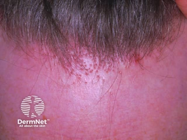 About frontal fibrosing alopecia (FFA) – LostEyebrows.org